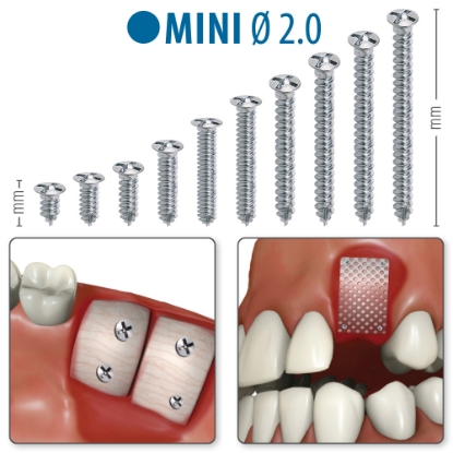 HANSAmed Limited. Screws & Tacks